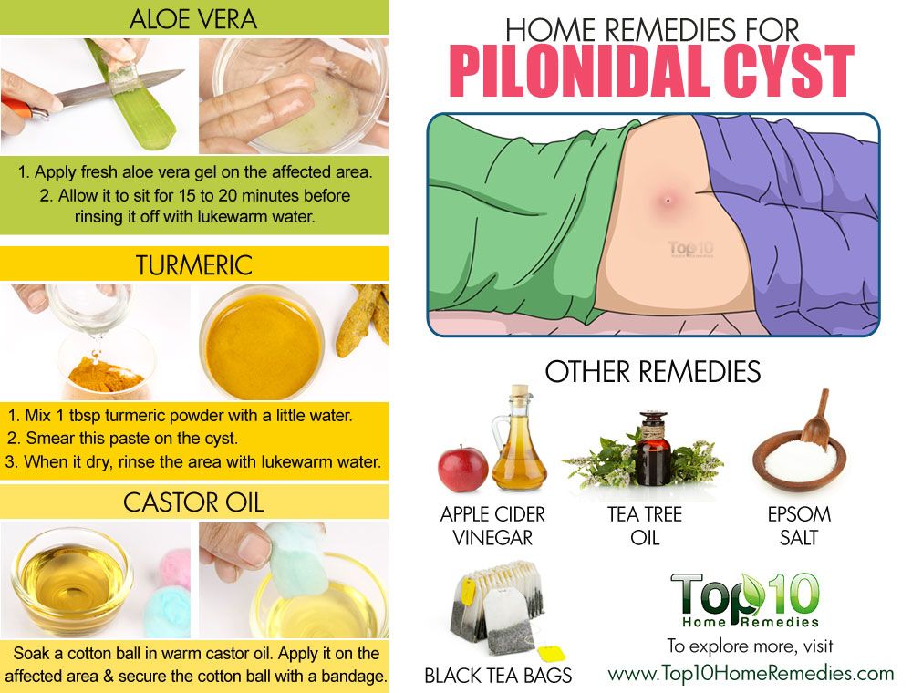 Home Remedies For Pilonidal Cysts Large Pimple At Bottom Of Tailbone Home Remedies For Pilonidal Cysts Large Pimple At Bottom Of Tailbone